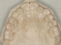 Triad-Based Occlusal Splints for Safety
