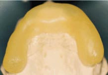 Triad-Based Occlusal Splints for Safety