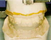 Triad-Based Occlusal Splints for Safety