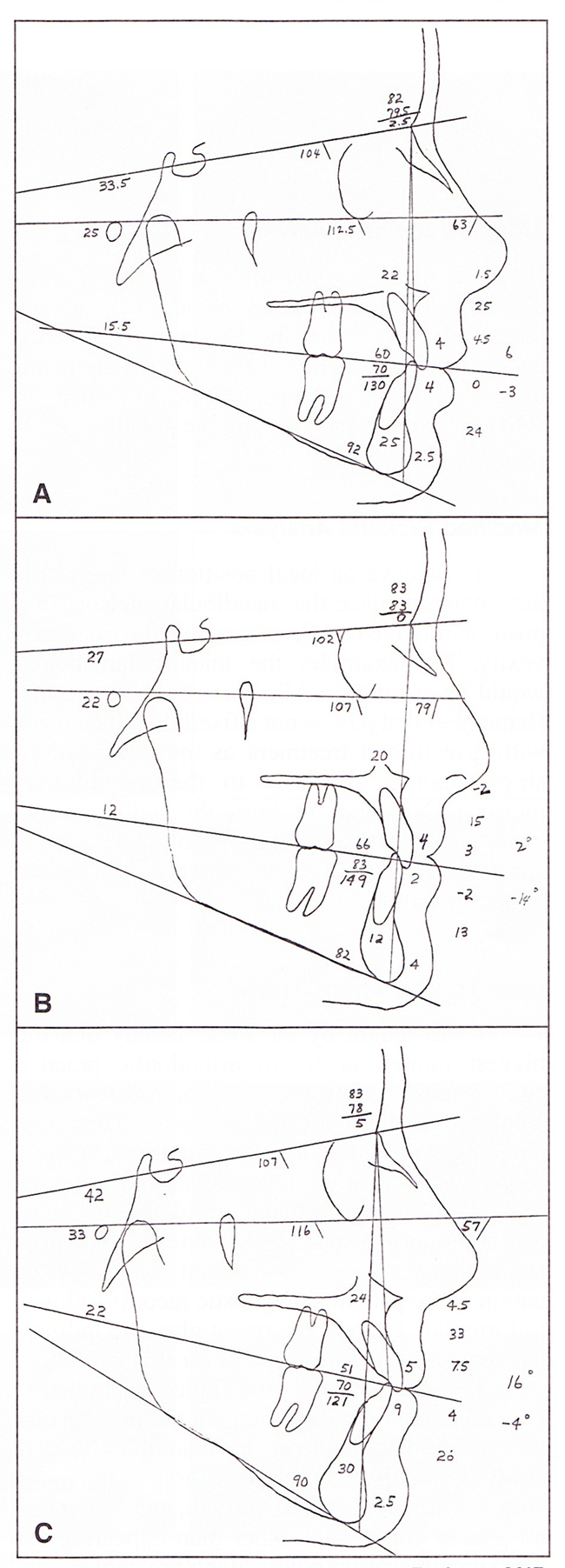 Optimum Teeth Positioning Based on Maxillary Incisors