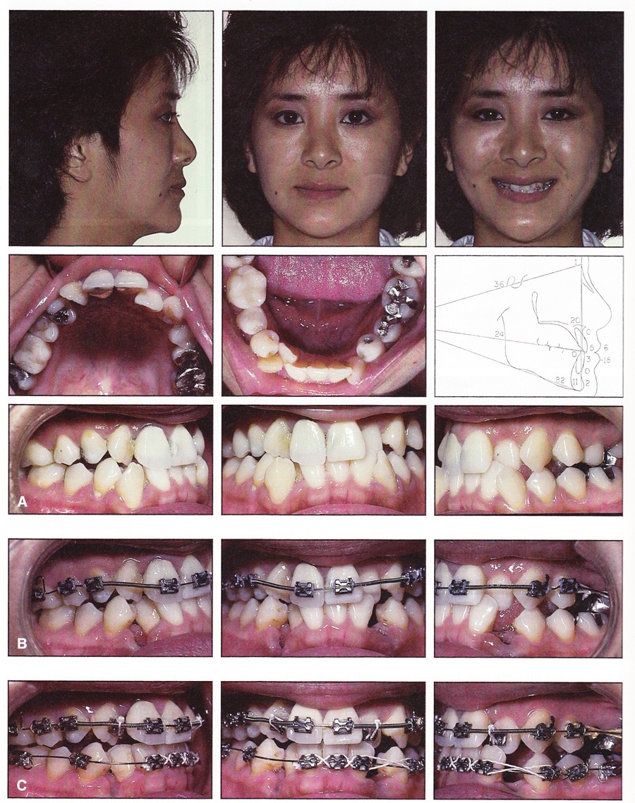 Optimum Teeth Positioning Based on Maxillary Incisors