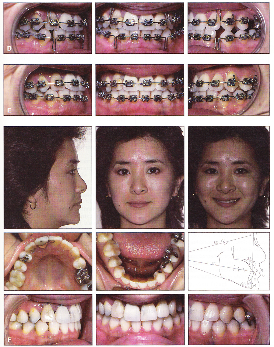 Where Teeth Should Be Positioned in the Face and Jaws and How To Get ...