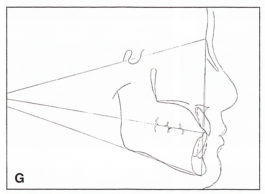 Optimum Teeth Positioning Based on Maxillary Incisors