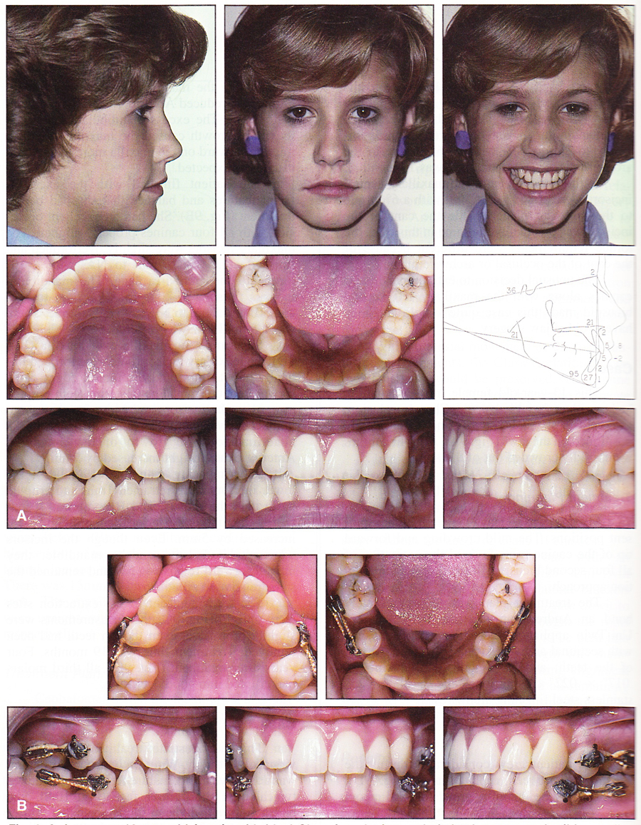 Optimum Teeth Positioning Based on Maxillary Incisors