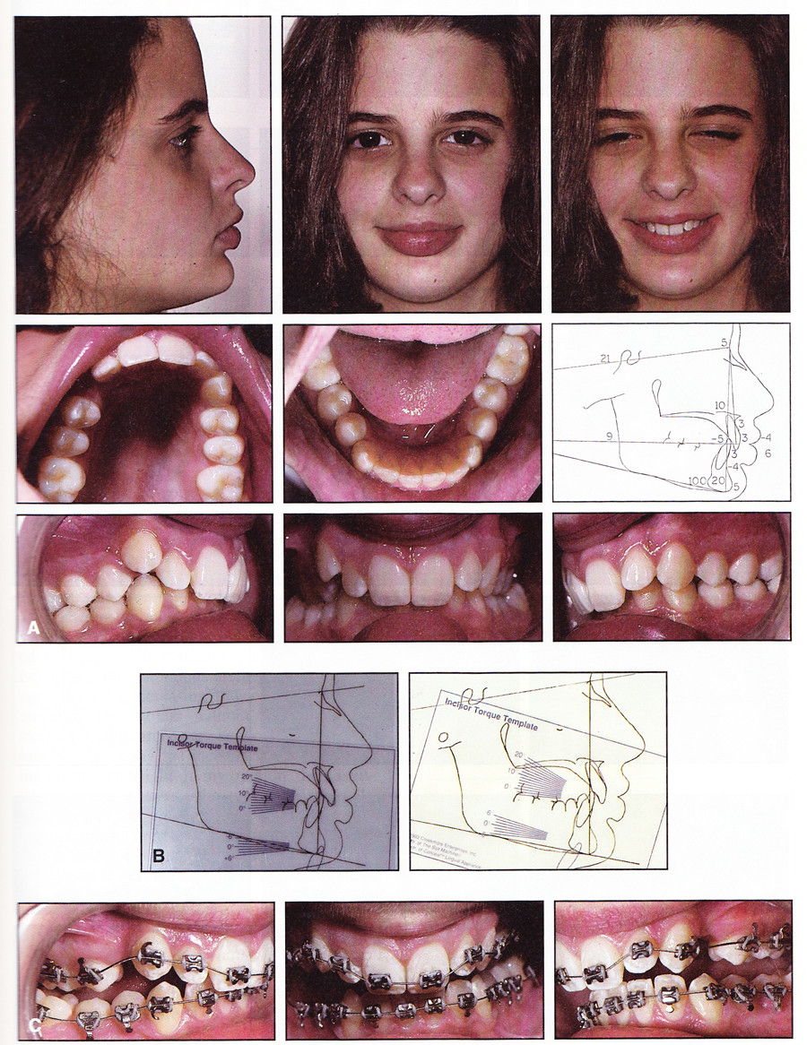 Optimum Teeth Positioning Based on Maxillary Incisors