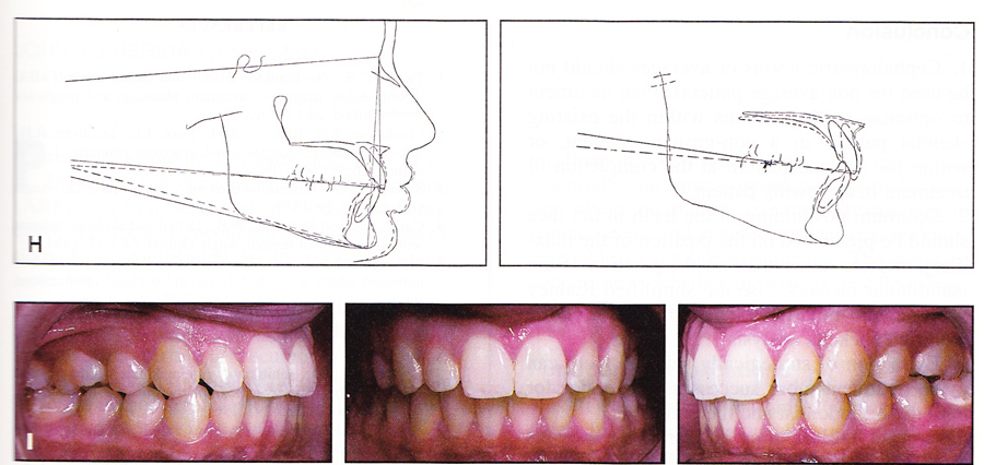 Where Teeth Should Be Positioned in the Face and Jaws and How To Get ...