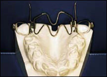 Case for Slow, Rather Than Rapid, Maxillary Expansion