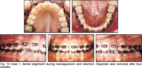 Case for Slow, Rather Than Rapid, Maxillary Expansion
