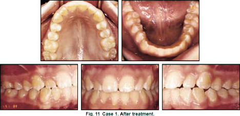 Case for Slow, Rather Than Rapid, Maxillary Expansion