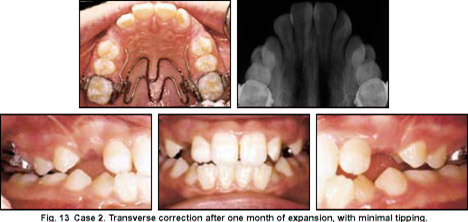 Case for Slow, Rather Than Rapid, Maxillary Expansion