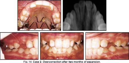 Case for Slow, Rather Than Rapid, Maxillary Expansion