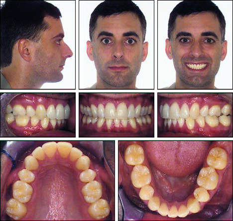 The Invisalign System in Adult Orthodontics: Mild Crowding and Space ...