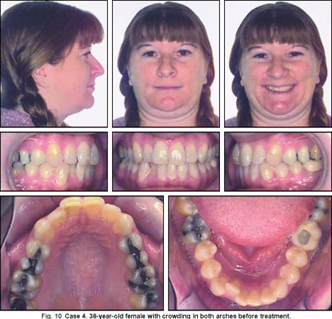 Aligner-Only Orthodontic Treatment