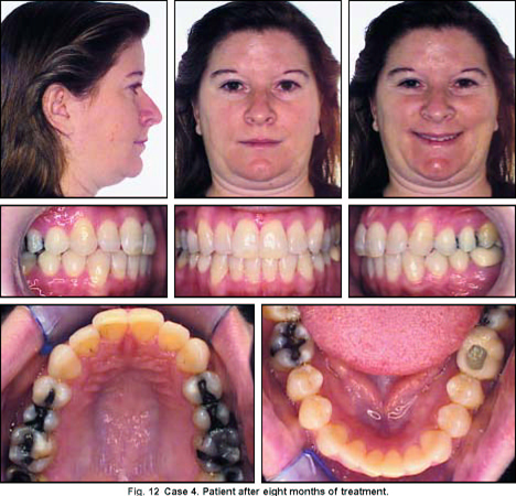 Aligner-Only Orthodontic Treatment