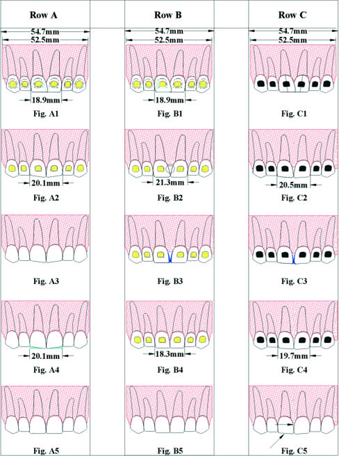 Congruent Surfaces Based Bonding System