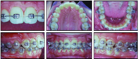 Congruent Surfaces Based Bonding System
