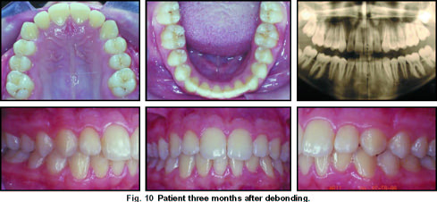 Congruent Surfaces Based Bonding System