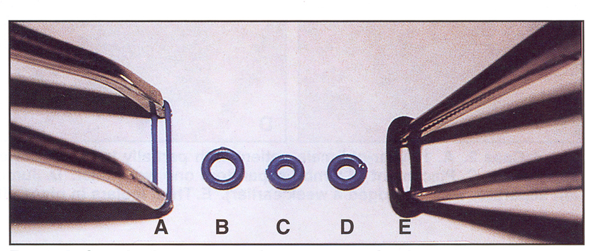 Thick Black Rubber O Rings for Freeing Impacted Molars