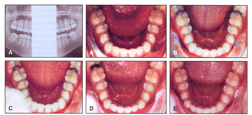 Thick Black Rubber O Rings for Freeing Impacted Molars