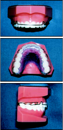JCO Pearl: Maxillary Wraparound Retainer for Second Molars