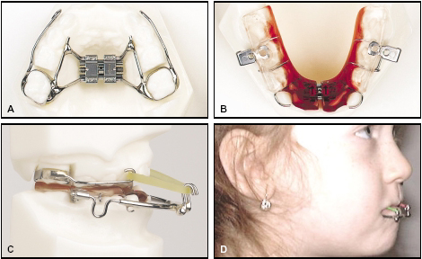 Modified Tandem Appliance for Non-Facemask Class III