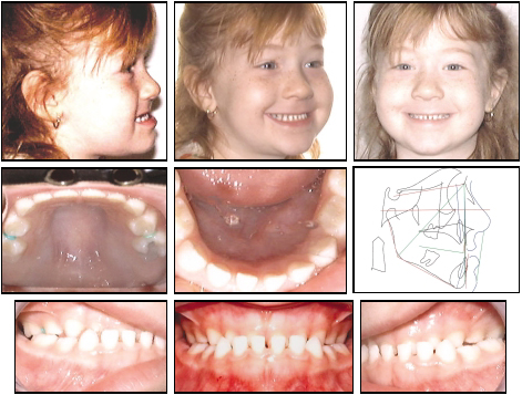 Modified Tandem Appliance for Non-Facemask Class III