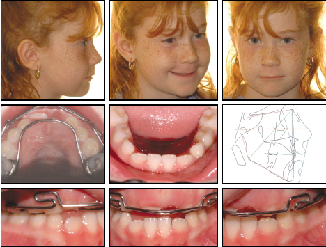 Early Orthopedic Class III Treatment with a Modified Tandem Appliance ...