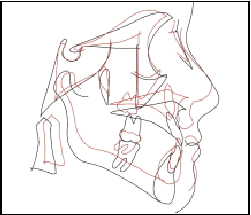 Modified Tandem Appliance for Non-Facemask Class III