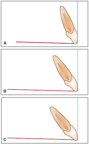 Importance of the Occlusal Plane in Virtual Treatment Planning - JCO ...