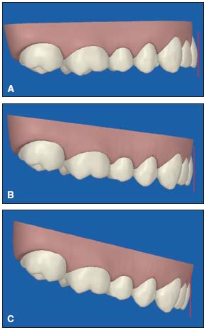 Importance of the Occlusal Plane in Virtual Treatment Planning - JCO ...
