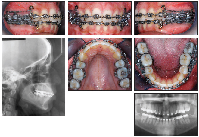 En-Masse Retraction Using Skeletal Anchorage in the Tuberosity and ...