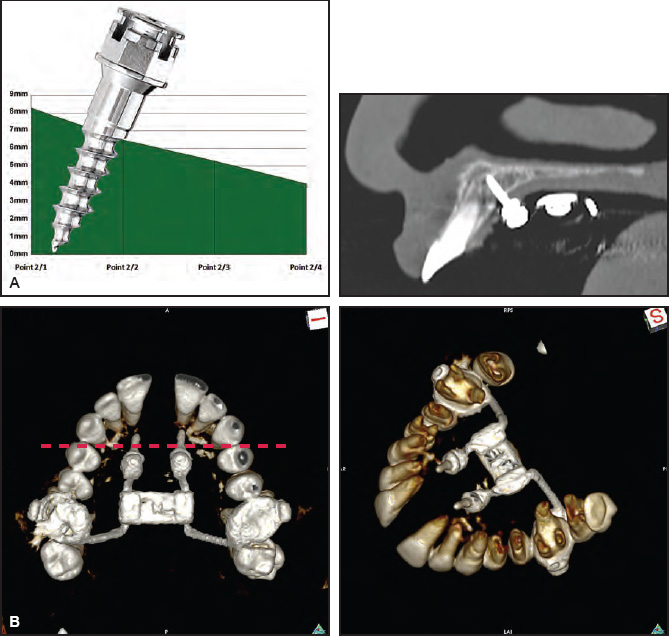 OVERVIEW Anatomical Guidelines for Miniscrew Insertion: Palatal Sites ...