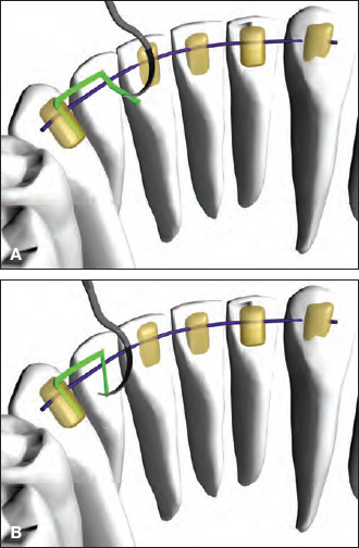 Anterior Torque Correction with Bracketless Fixed Orthodontics - JCO ...