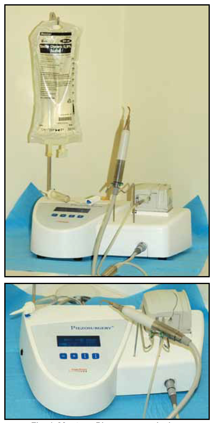 Corticotomy-Enhanced Intrusion of an Overerupted Molar Using Skeletal ...