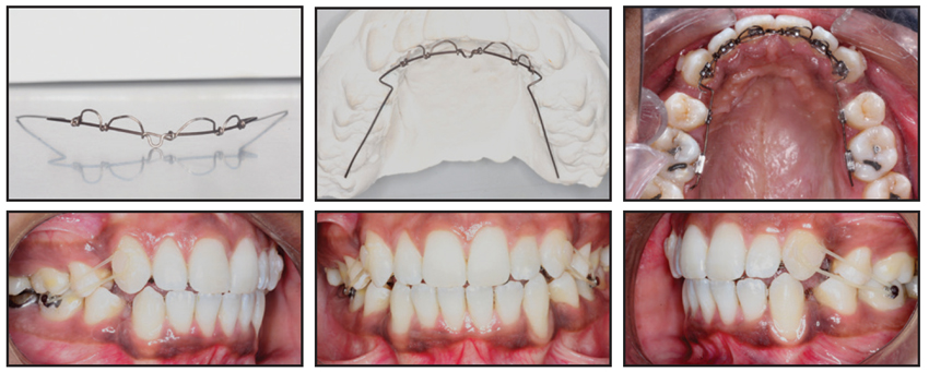 The Rat Trap Lingual Torquing Auxiliary - JCO Online - Journal of ...