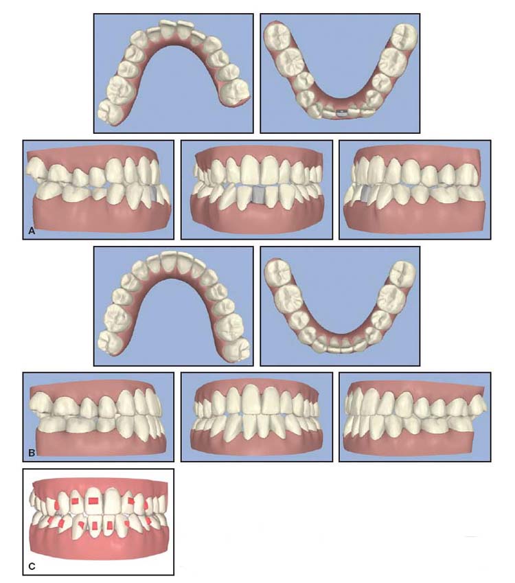 Invisalign Treatment of Class III Malocclusion with Lower-Incisor ...