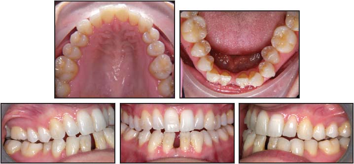 Invisalign Treatment of Class III Malocclusion with Lower-Incisor ...
