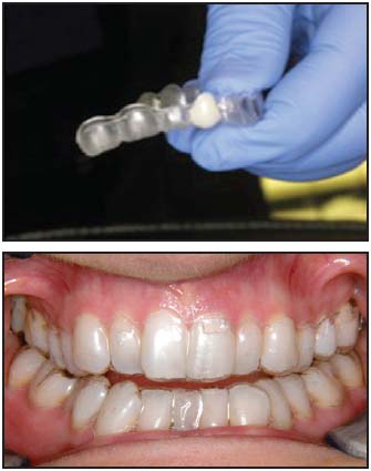 Invisalign Treatment of Class III Malocclusion with Lower-Incisor ...