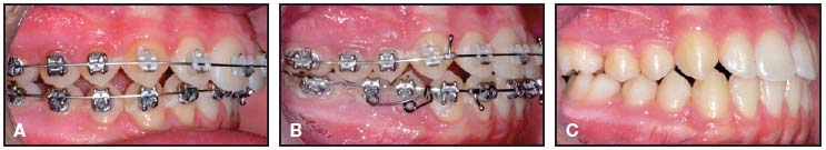 Uses of the Vertical Slot in Orthodontic Brackets - JCO Online