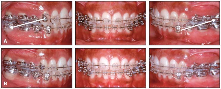 Uses of the Vertical Slot in Orthodontic Brackets - JCO Online