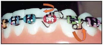 Uses of the Vertical Slot in Orthodontic Brackets - JCO Online
