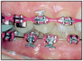 Uses of the Vertical Slot in Orthodontic Brackets - JCO Online