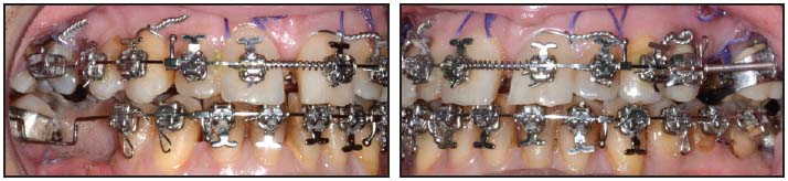 Uses of the Vertical Slot in Orthodontic Brackets - JCO Online