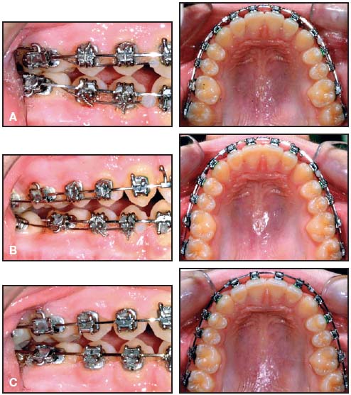 Uses of the Vertical Slot in Orthodontic Brackets - JCO Online