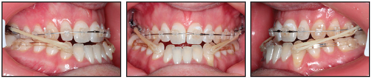 Nonsurgical Correction of Severe Skeletal Class III Malocclusion - JCO ...