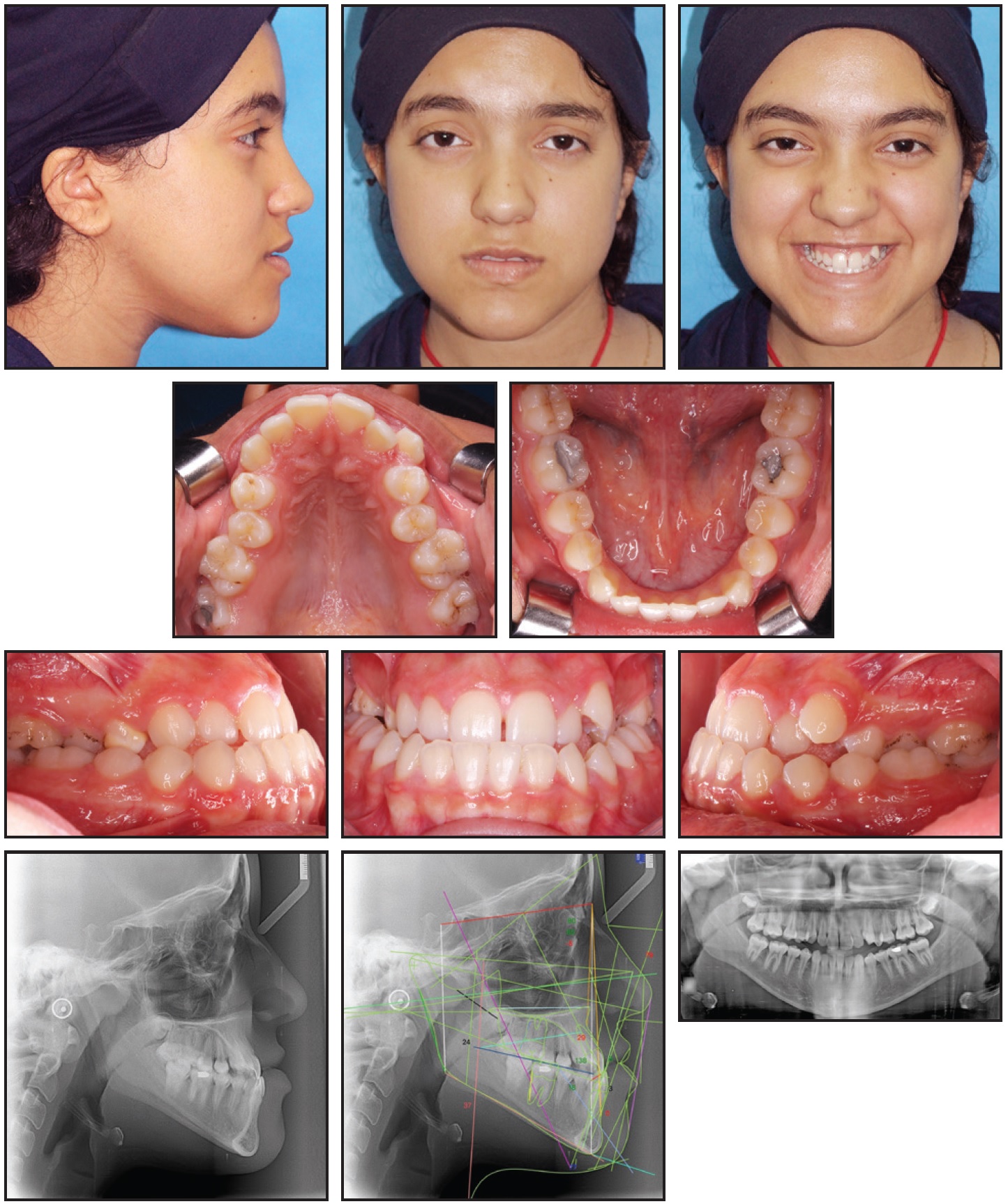 CASE REPORT JCO Online Journal Of Clinical Orthodontics CASE REPORT JCO Online Journal Of Clinical Orthodontics